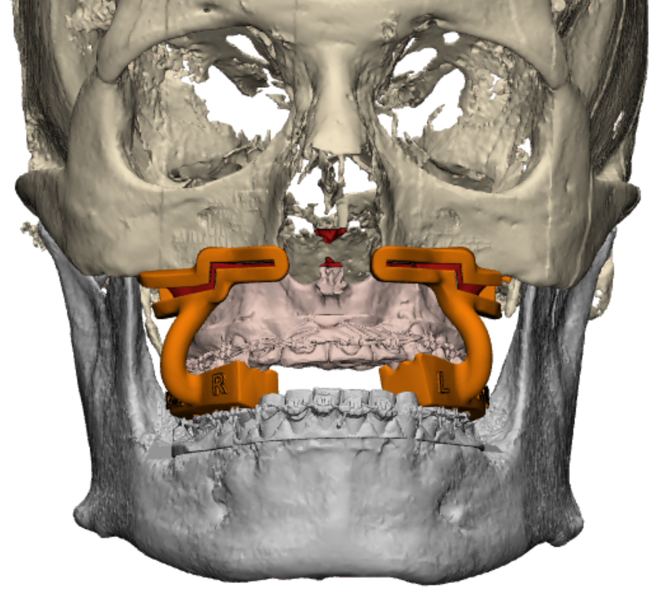 Vertical Maxillary Deficiency - Synergy3DMed