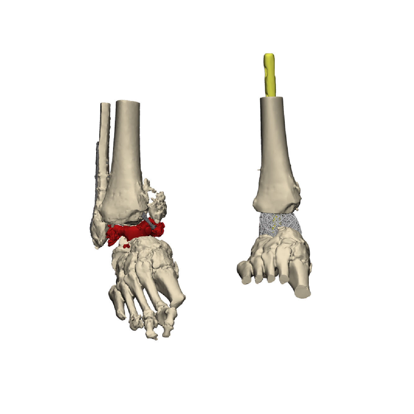 Talus Implant - Synergy3DMed