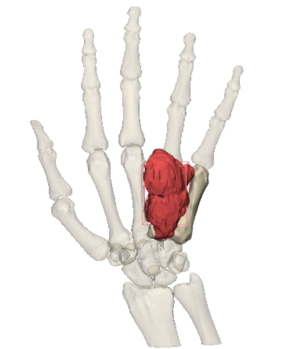 Palm Tumor Resection - Synergy3DMed