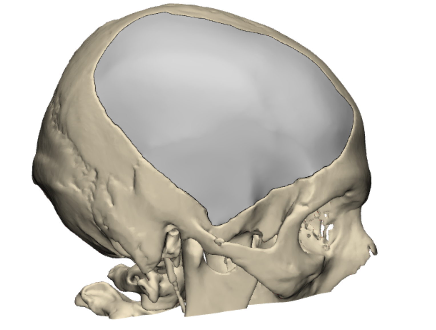 Cranioplasty - Synergy3DMed