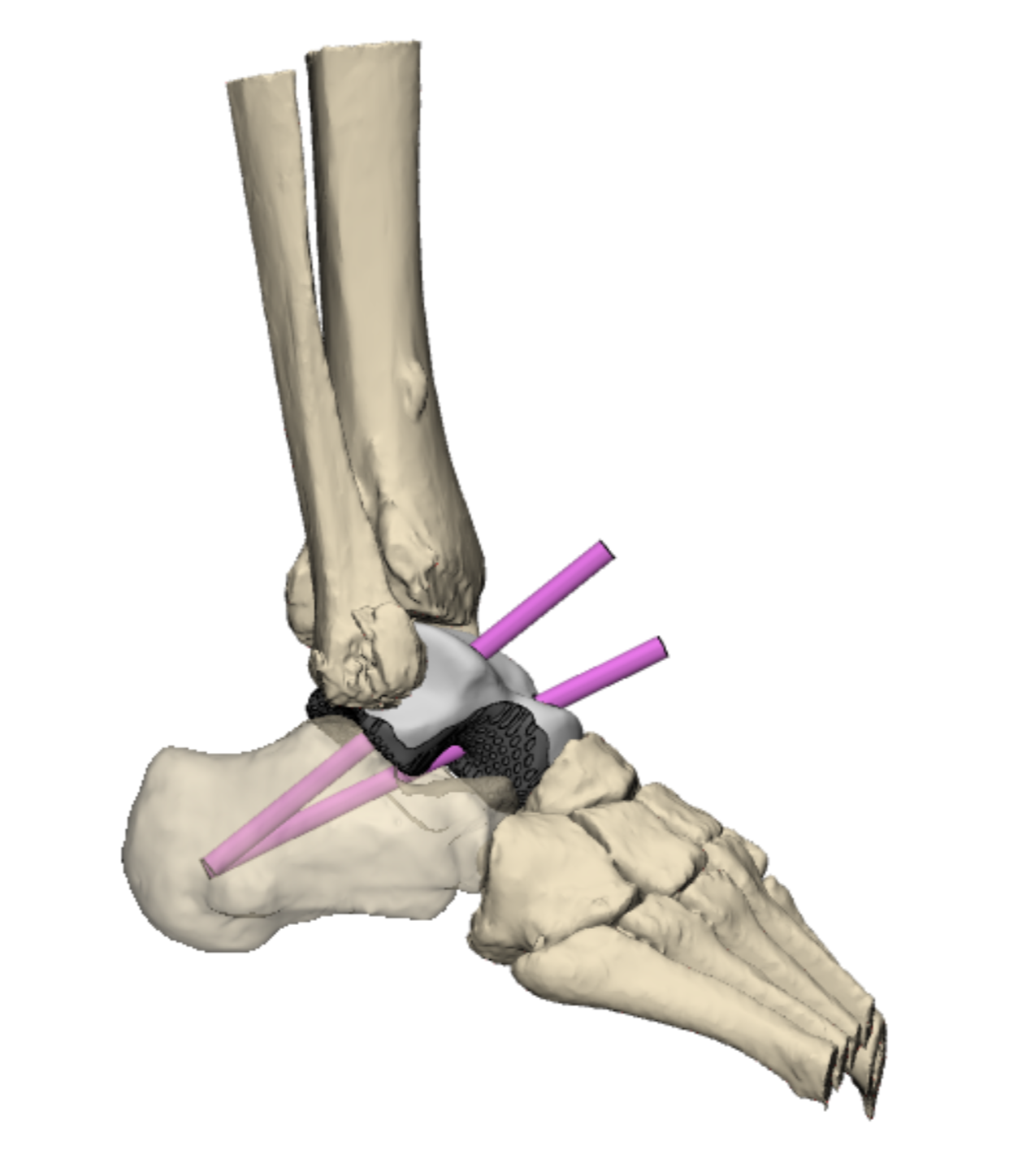 3D printed Talus implant - Synergy3DMed